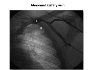 Technic venous access for permanent pacemaker implantation | PPTX