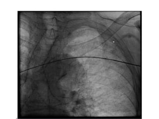 Technic venous access for permanent pacemaker implantation | PPTX