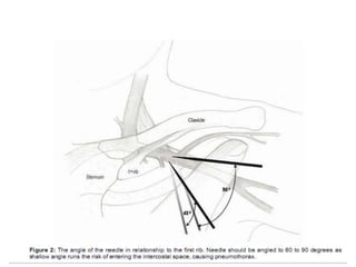 Technic venous access for permanent pacemaker implantation | PPTX