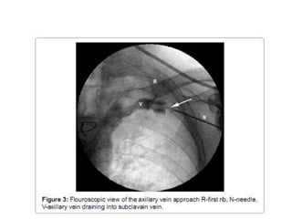 Technic venous access for permanent pacemaker implantation | PPTX