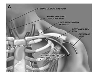 Technic venous access for permanent pacemaker implantation | PPTX