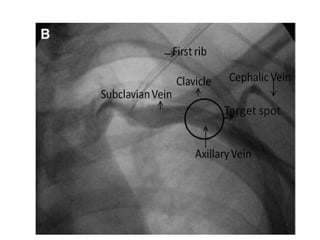 Technic venous access for permanent pacemaker implantation | PPTX