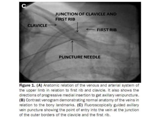 Technic venous access for permanent pacemaker implantation | PPTX