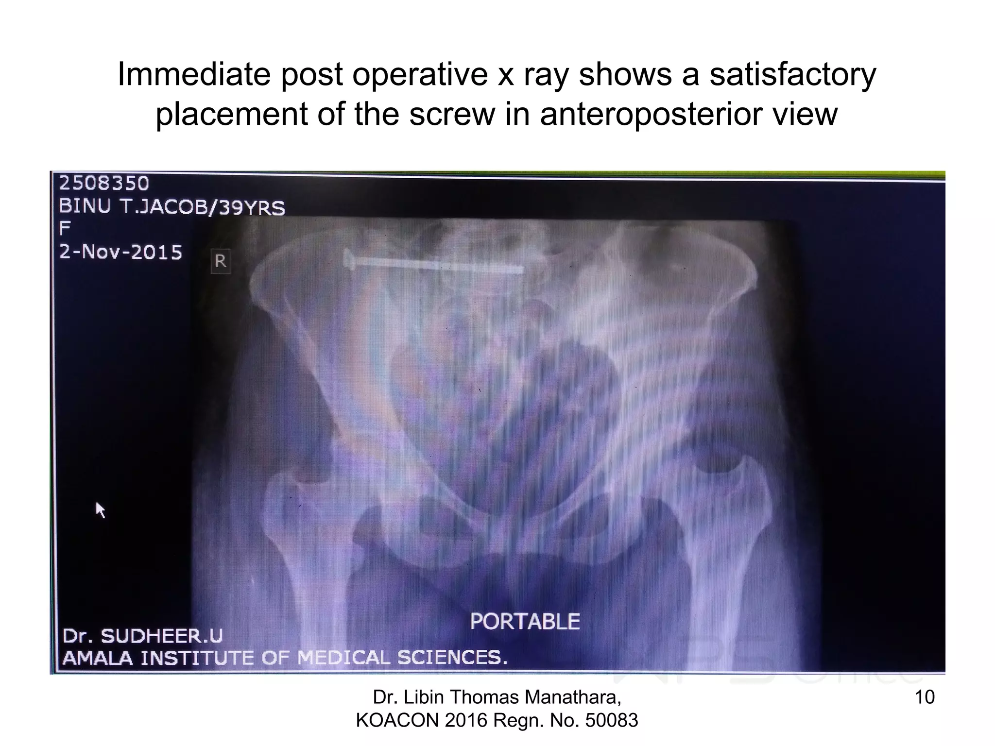 Technique of percutaneous iliosacral screw fixation of sacroiliac ...