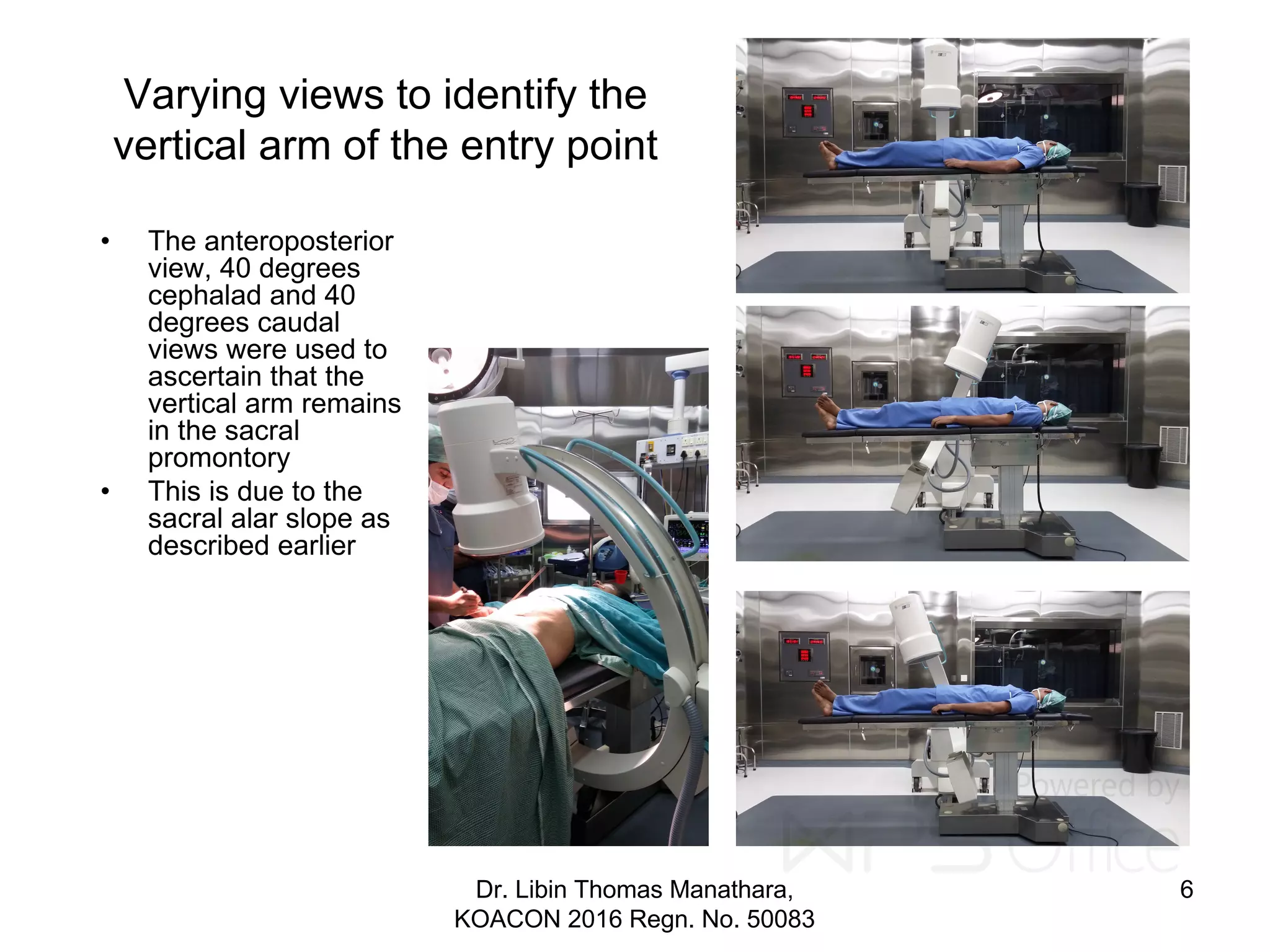 Technique of percutaneous iliosacral screw fixation of sacroiliac ...