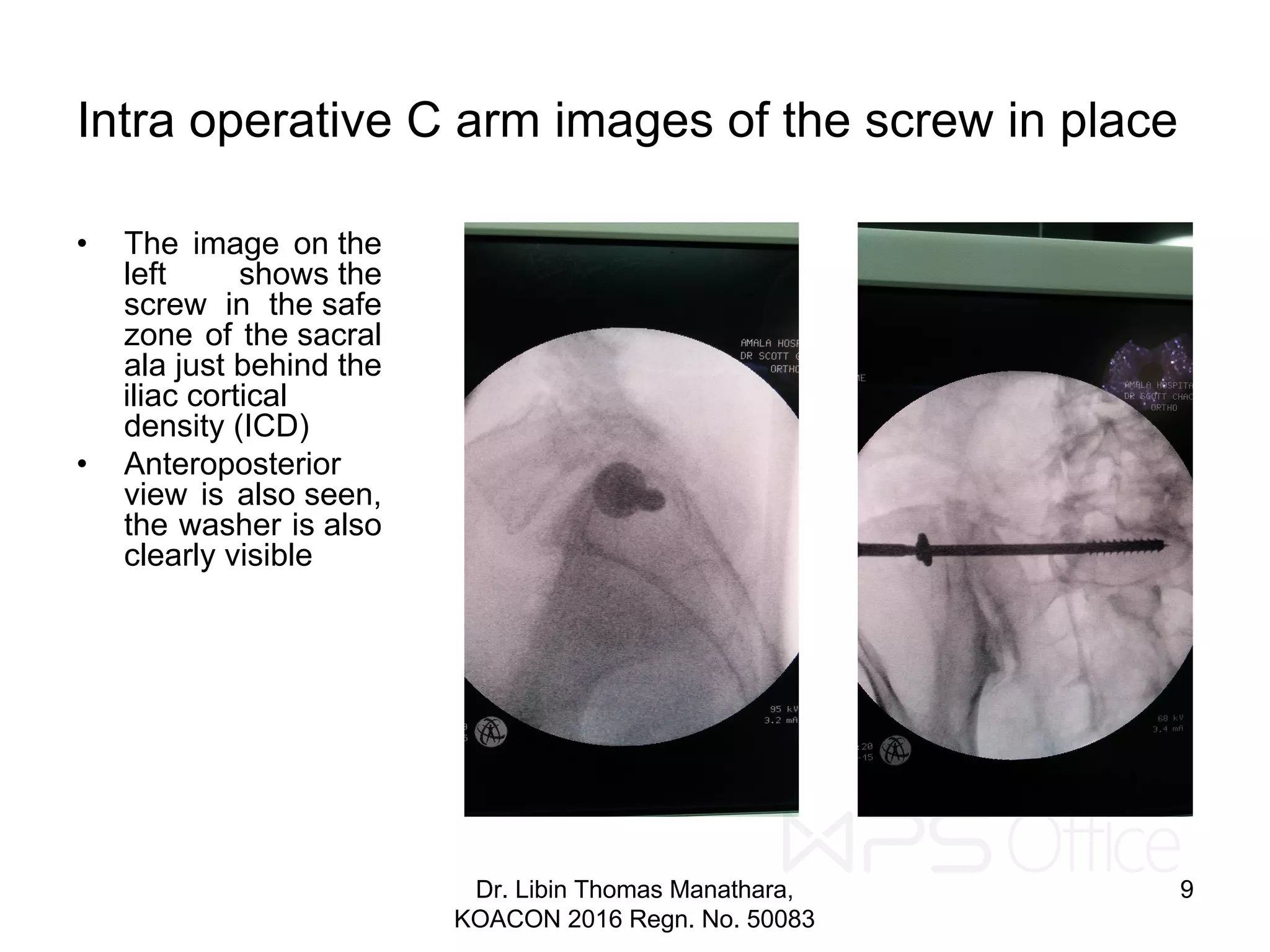 Technique of percutaneous iliosacral screw fixation of sacroiliac ...
