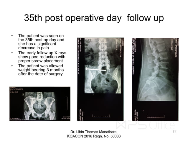 Technique of percutaneous iliosacral screw fixation of sacroiliac ...