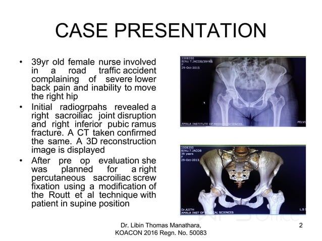 Technique of percutaneous iliosacral screw fixation of sacroiliac ...