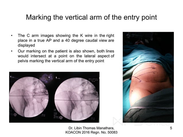 Technique of percutaneous iliosacral screw fixation of sacroiliac ...