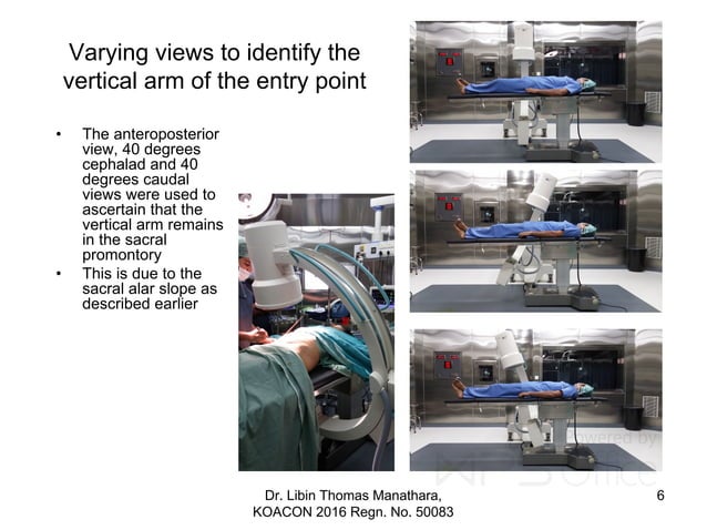 Technique of percutaneous iliosacral screw fixation of sacroiliac ...