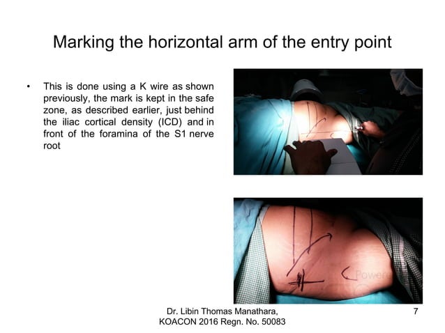 Technique of percutaneous iliosacral screw fixation of sacroiliac ...
