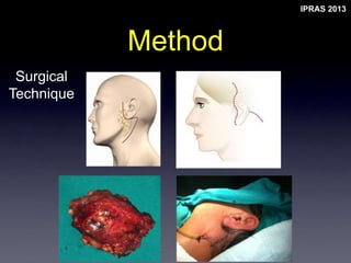 PARTIAL SUPERFICIAL PAROTIDECTOMY WITH FACELIFT INCISION. IPRAS | PPT