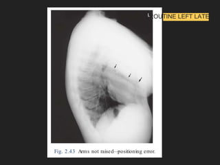 Technique cxr | PPTX