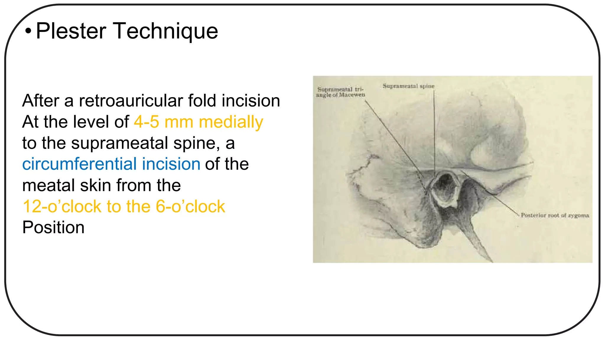 Technique of harvesting cartilage graft for cartilage tympanoplasty Dr ...