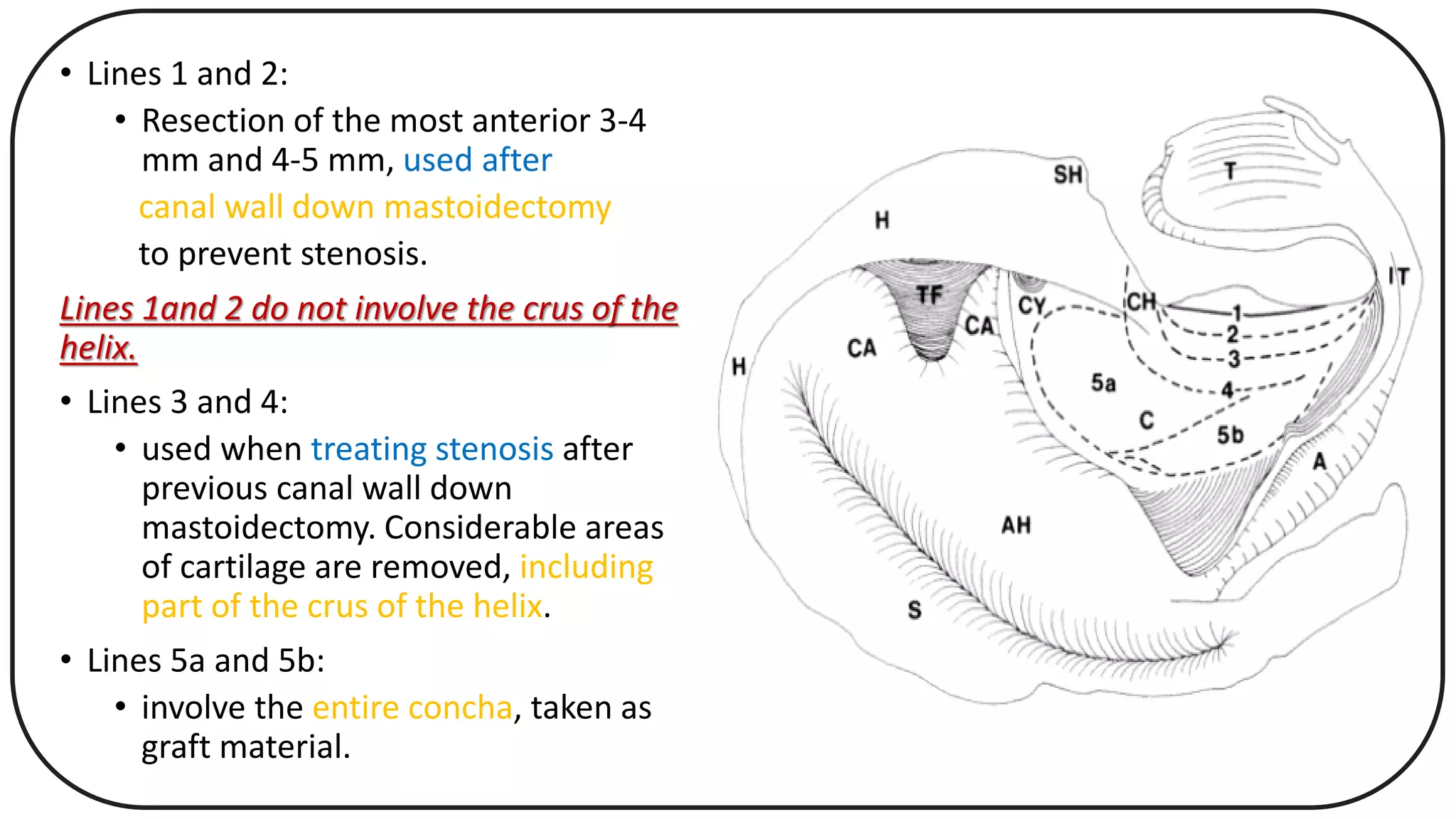 Technique of harvesting cartilage graft for cartilage tympanoplasty Dr ...