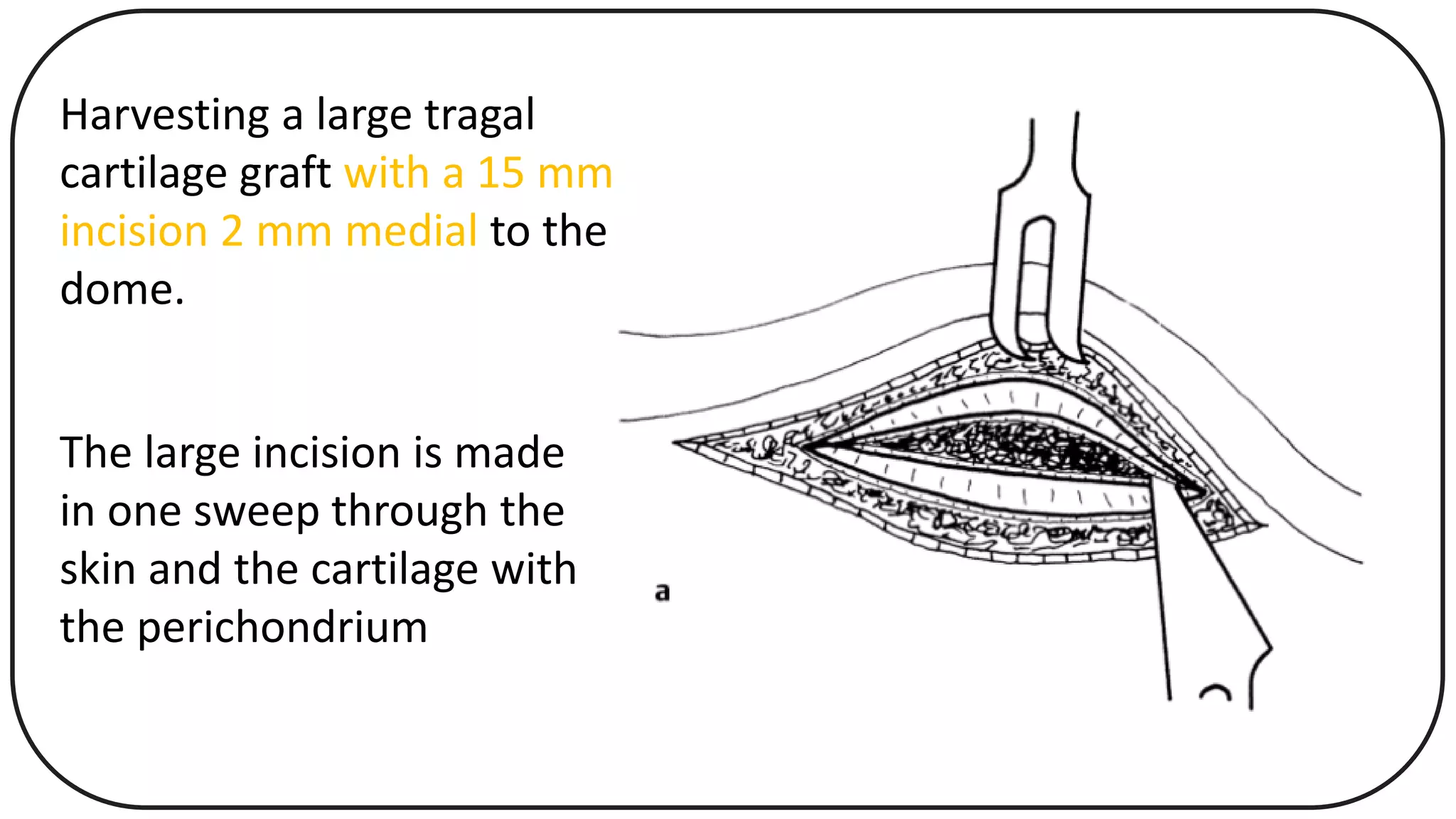 Technique of harvesting cartilage graft for cartilage tympanoplasty Dr ...