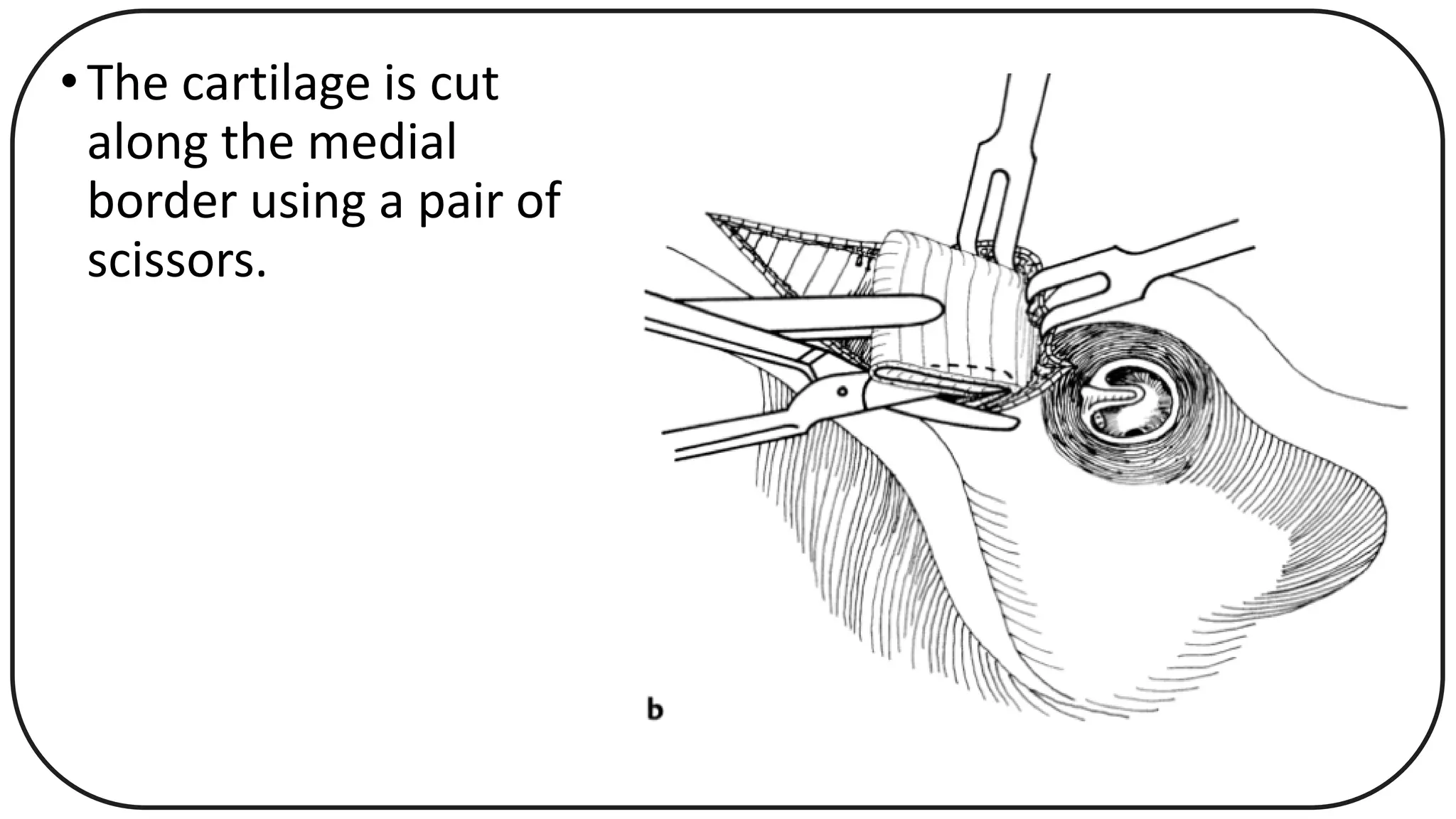 Technique of harvesting cartilage graft for cartilage tympanoplasty Dr ...