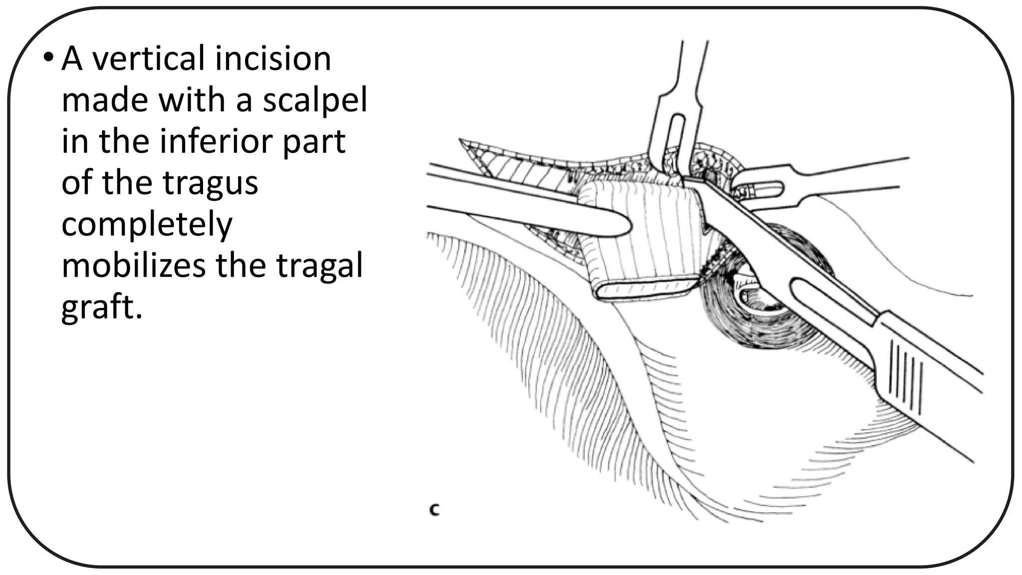 Technique of harvesting cartilage graft for cartilage tympanoplasty Dr ...