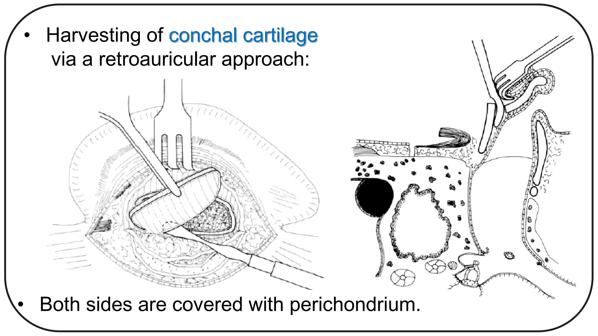 Technique of harvesting cartilage graft for cartilage tympanoplasty Dr ...