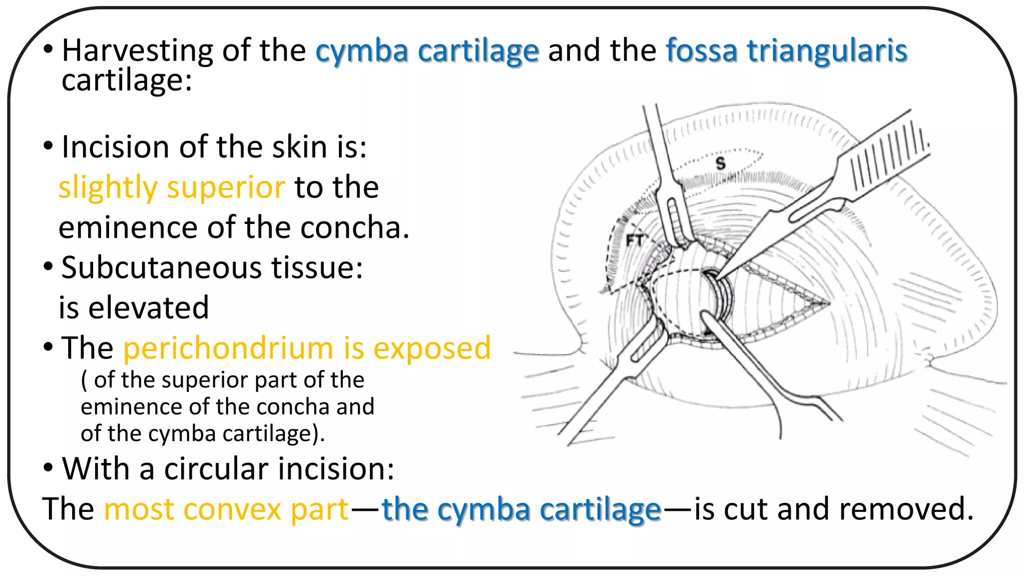 Technique of harvesting cartilage graft for cartilage tympanoplasty Dr ...