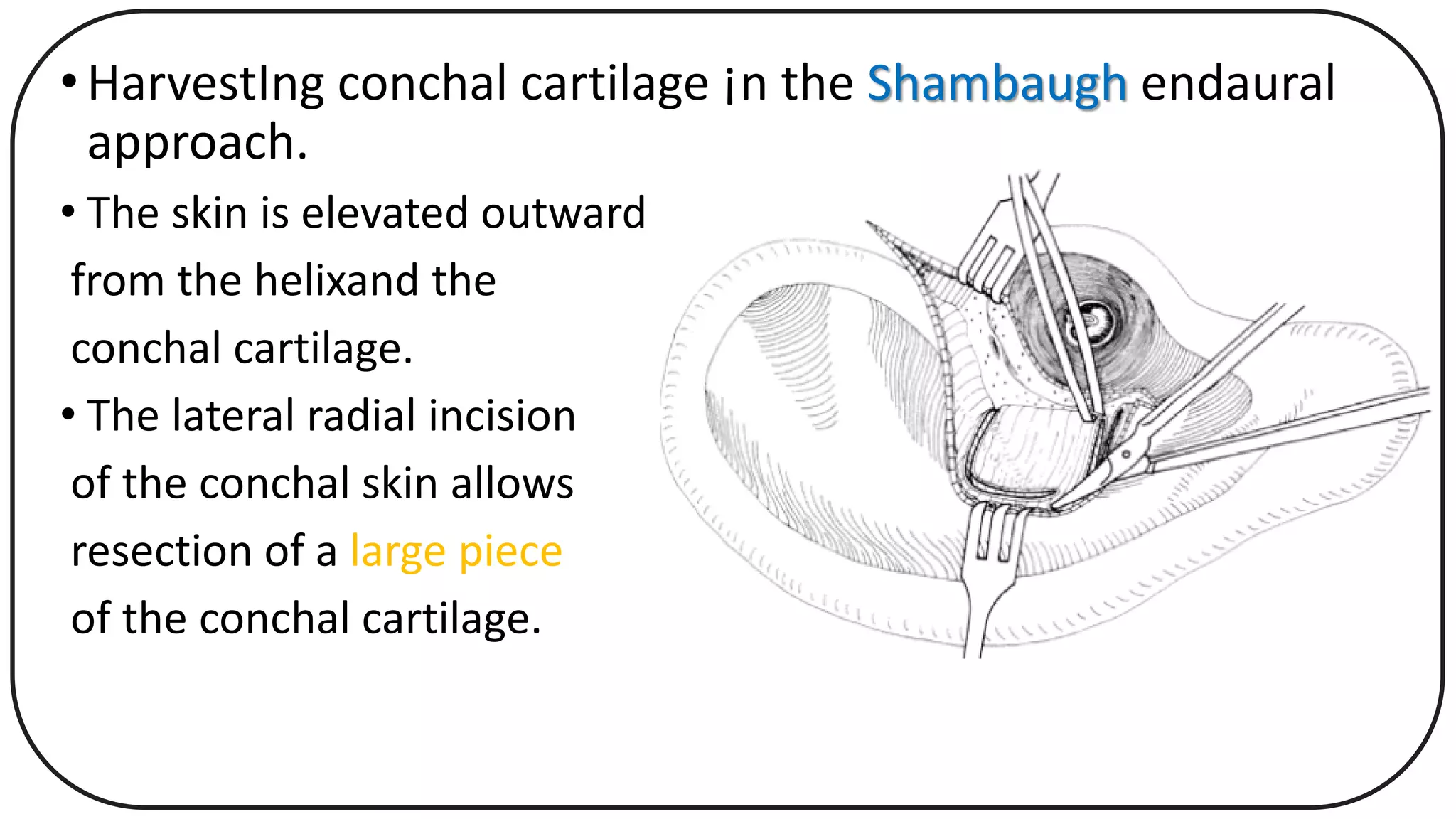Technique of harvesting cartilage graft for cartilage tympanoplasty Dr ...