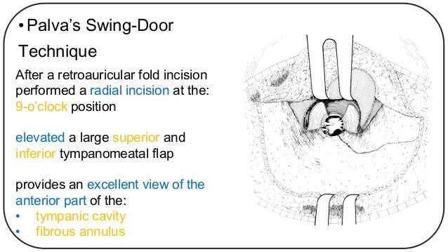 Technique of harvesting cartilage graft for cartilage tympanoplasty