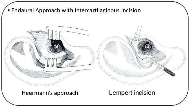 Technique of harvesting cartilage graft for cartilage tympanoplasty