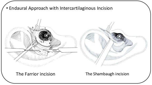 Technique of harvesting cartilage graft for cartilage tympanoplasty