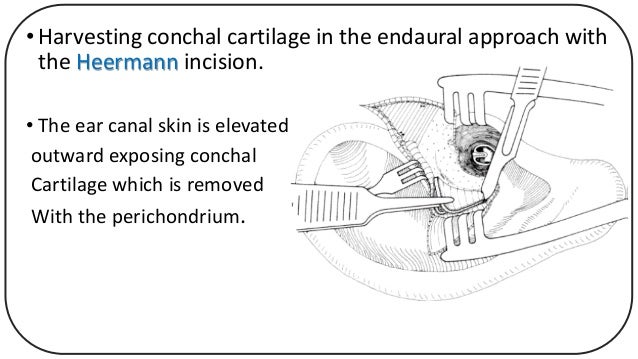 Technique of harvesting cartilage graft for cartilage tympanoplasty