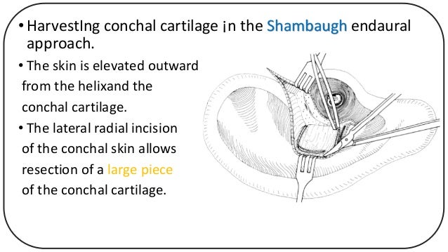 Technique of harvesting cartilage graft for cartilage tympanoplasty