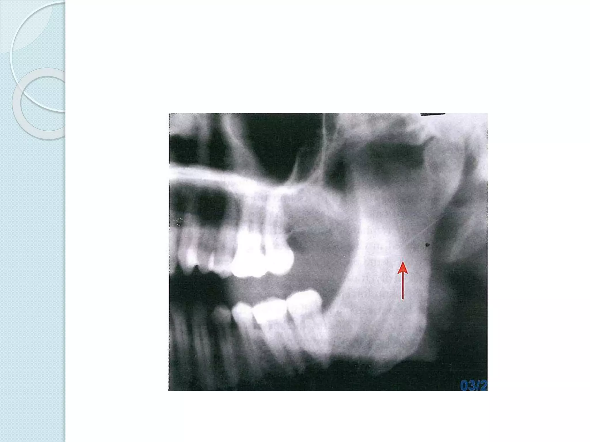 Technique of mandibular anesthesia | PPTX