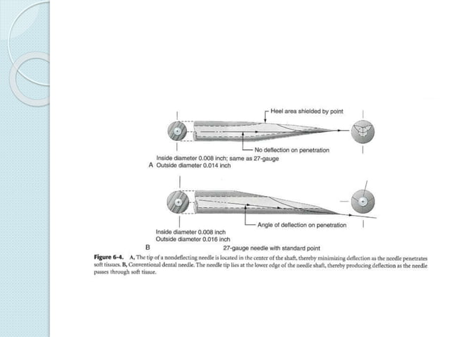 Technique of mandibular anesthesia | PPTX