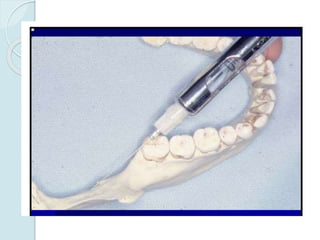 Technique of mandibular anesthesia | PPTX