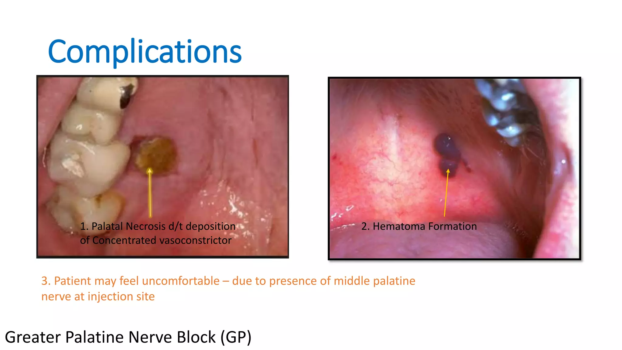 Technique of maxillary anesthesia | PPTX