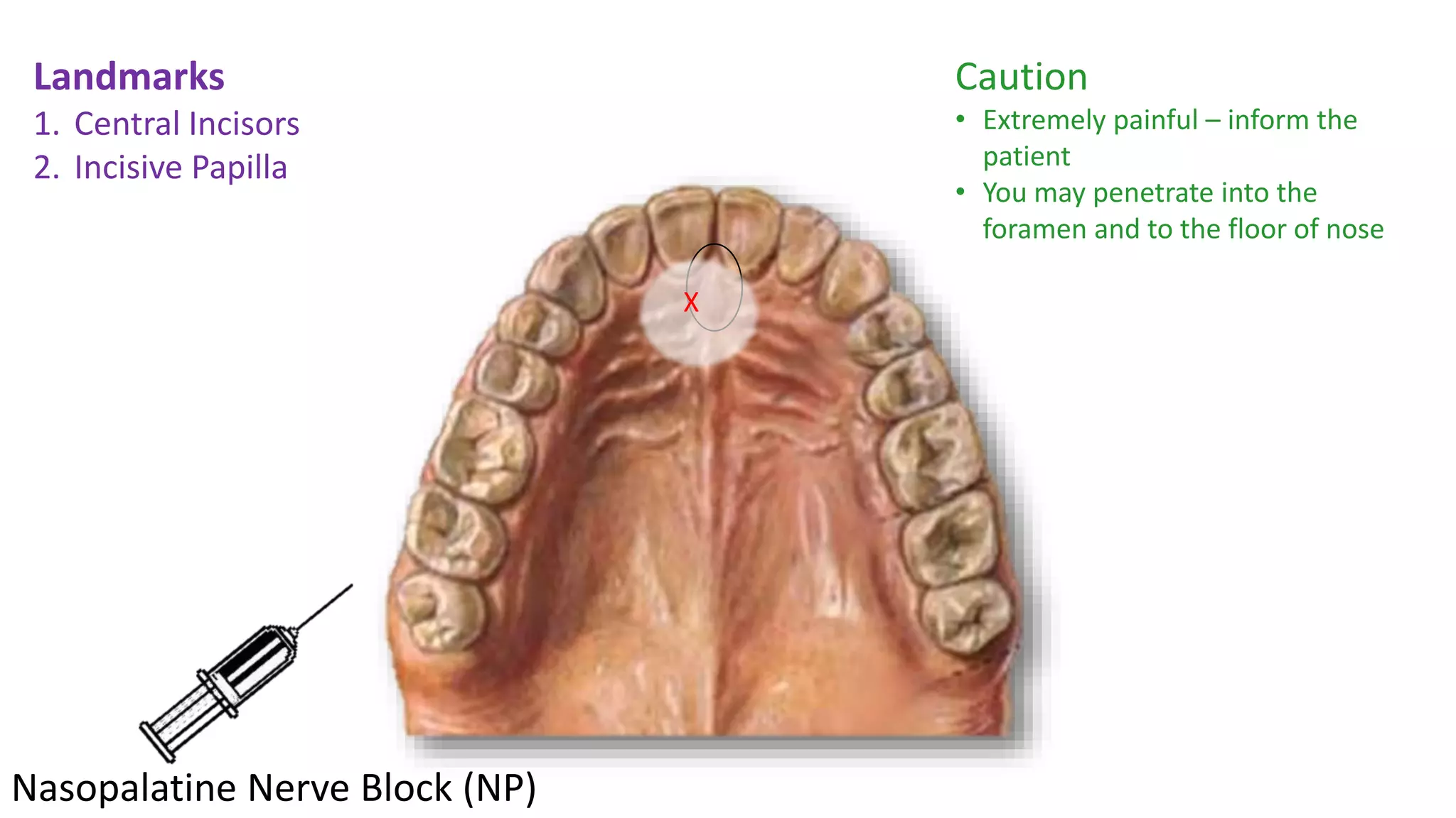 Technique of maxillary anesthesia | PPTX
