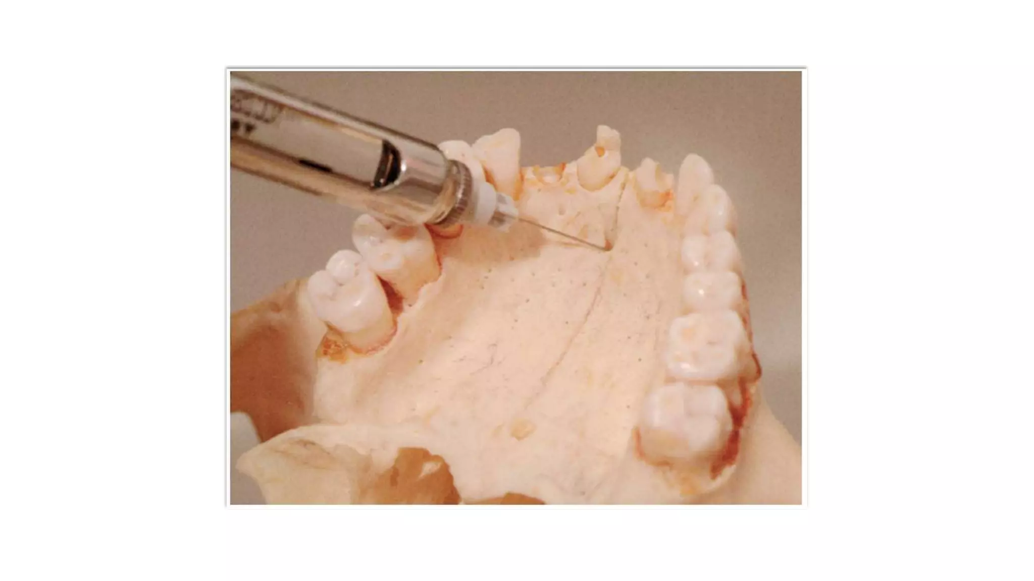 Technique of maxillary anesthesia | PPTX