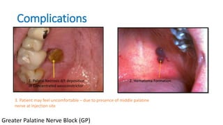 Technique of maxillary anesthesia | PPTX