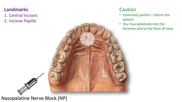 Technique of maxillary anesthesia | PPTX | Ear, Nose and Throat ...