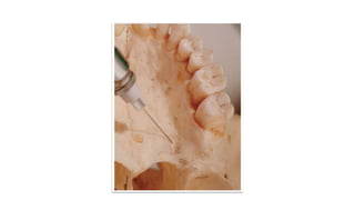 Technique of maxillary anesthesia | PPTX