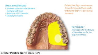 Technique of maxillary anesthesia | PPTX