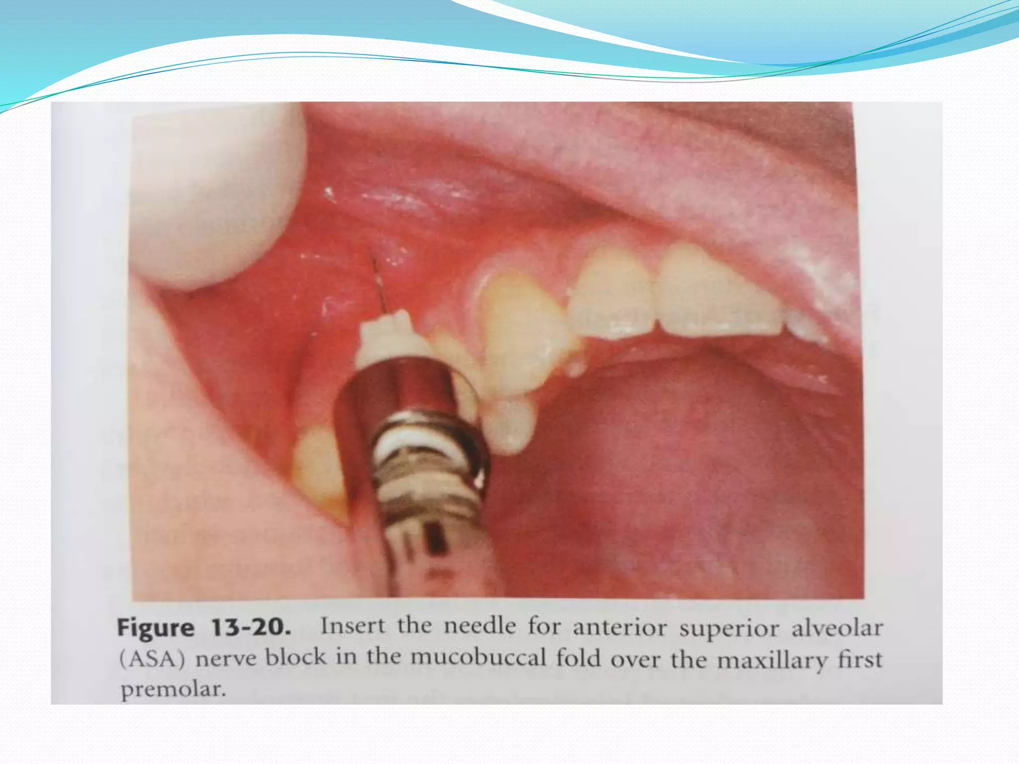 Technique of maxillay anesthesia | PPTX