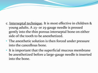 Technique of maxillay anesthesia | PPTX