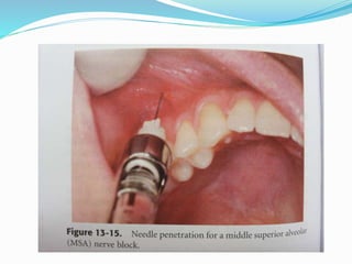 Technique of maxillay anesthesia | PPTX