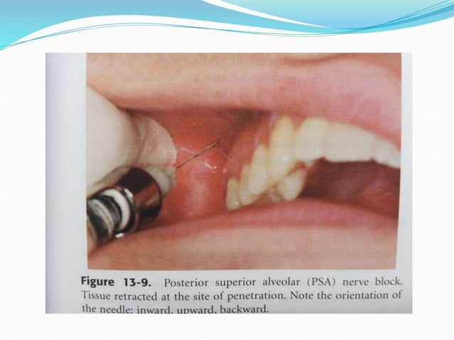 Technique of maxillay anesthesia | PPTX