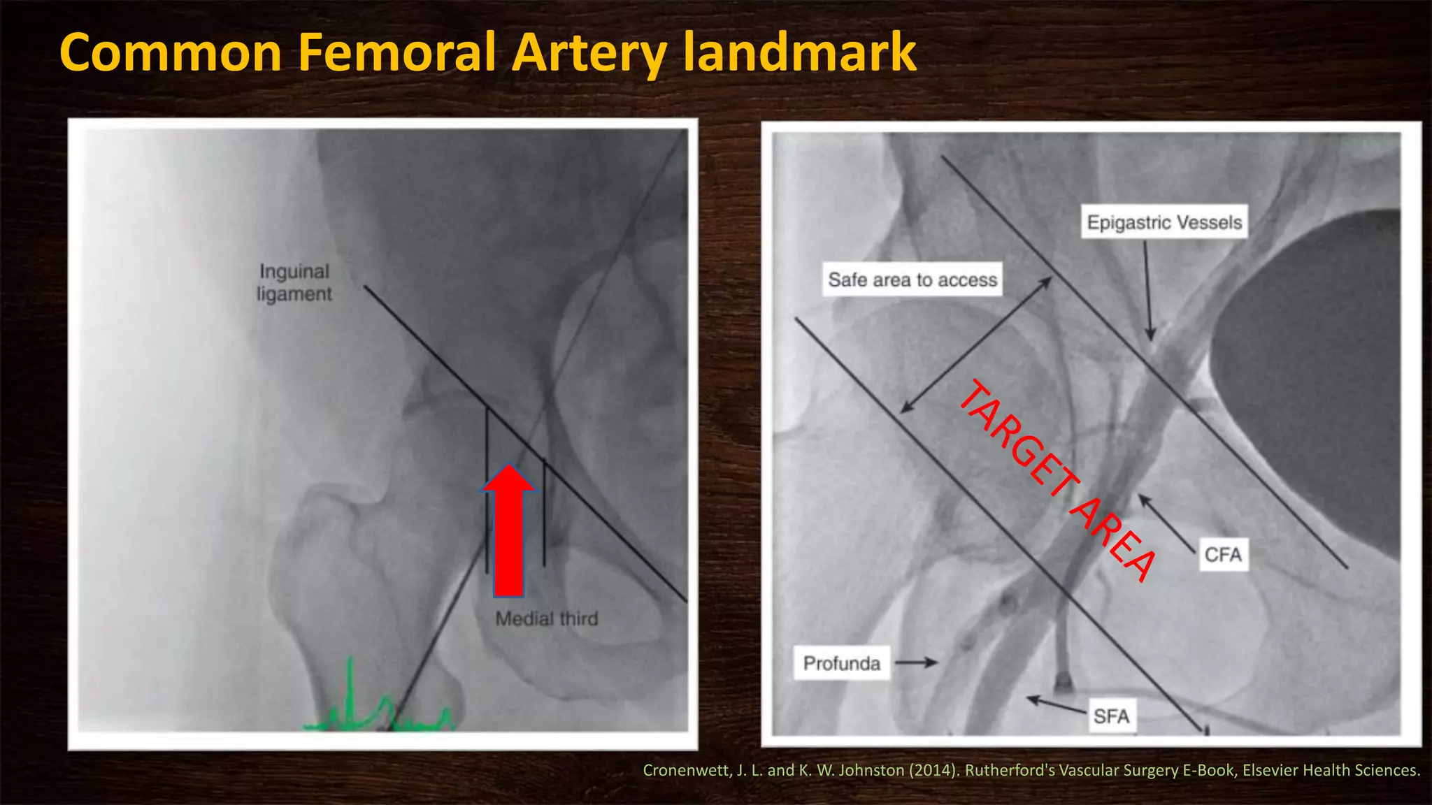 Technique of peripheral angiogram and complication | PPTX