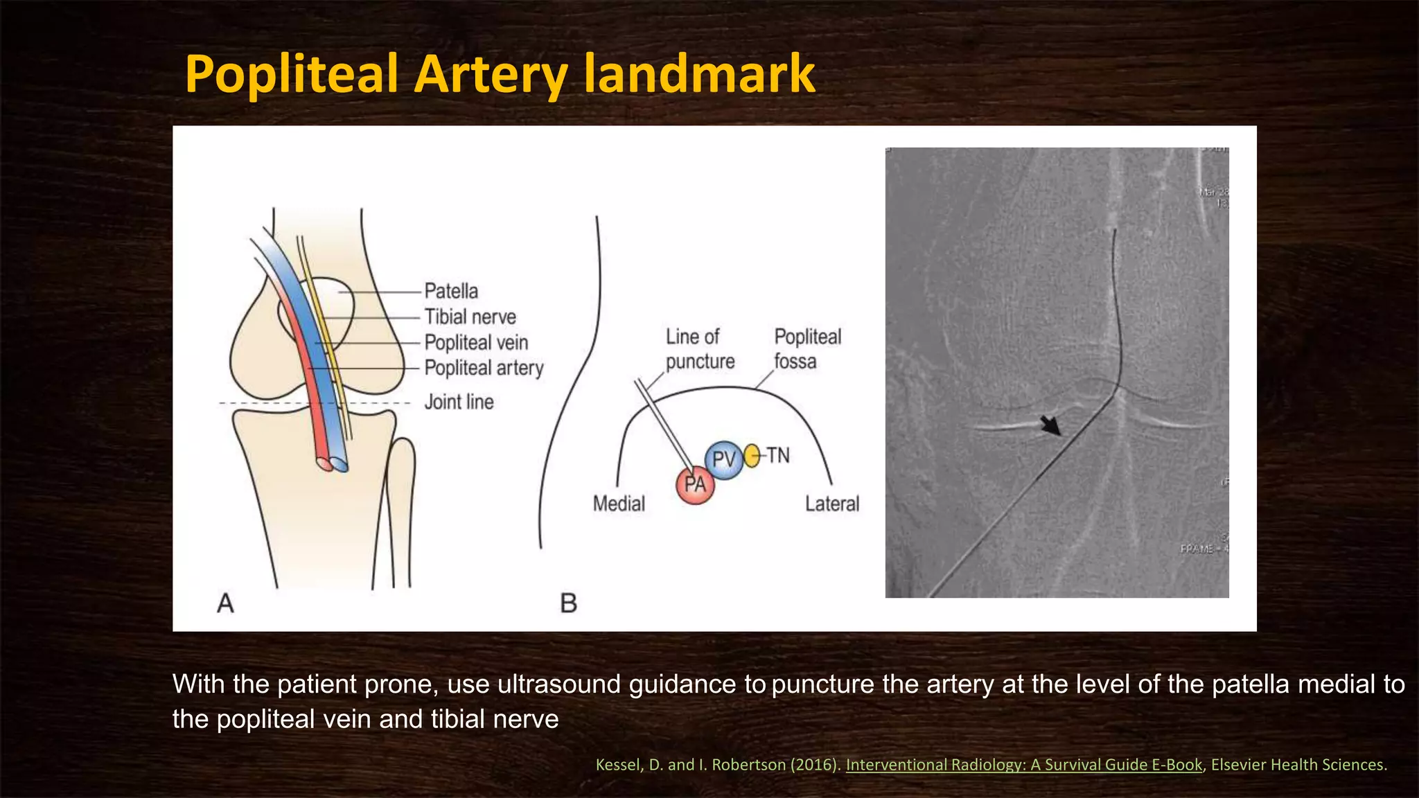 Technique of peripheral angiogram and complication | PPTX