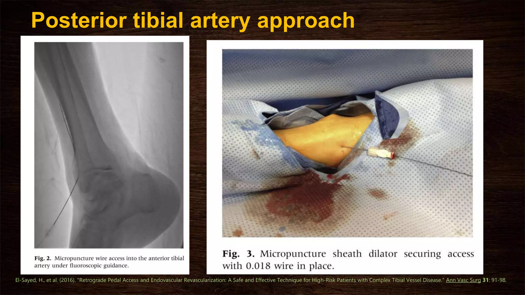 Technique of peripheral angiogram and complication | PPTX