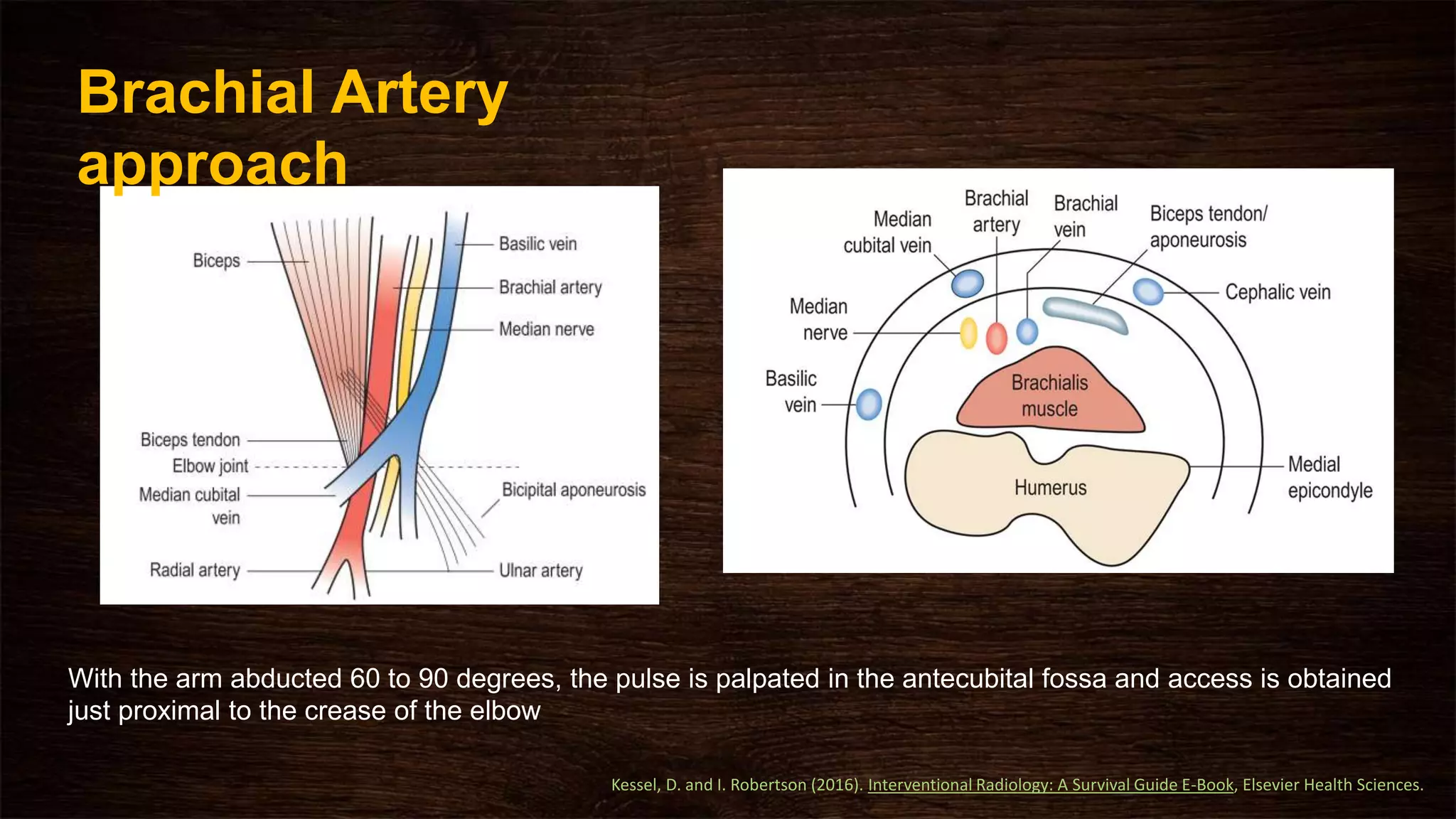 Technique of peripheral angiogram and complication | PPTX