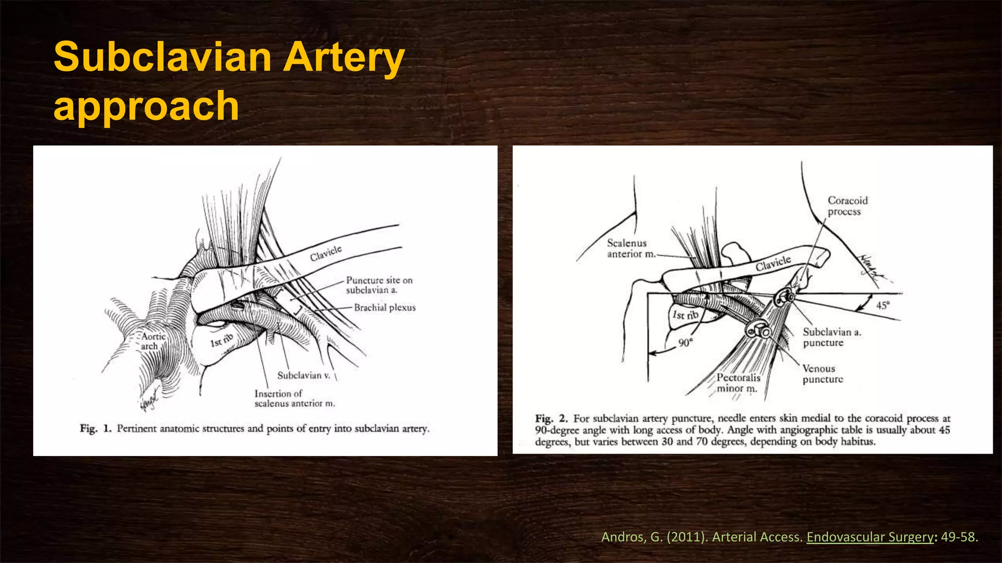 Technique of peripheral angiogram and complication | PPTX
