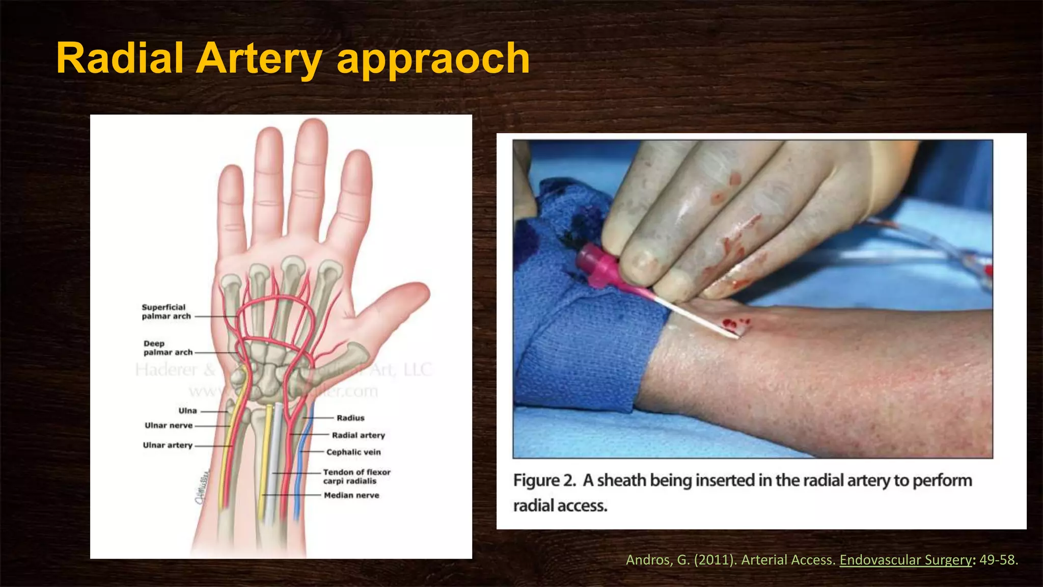 Technique of peripheral angiogram and complication | PPTX